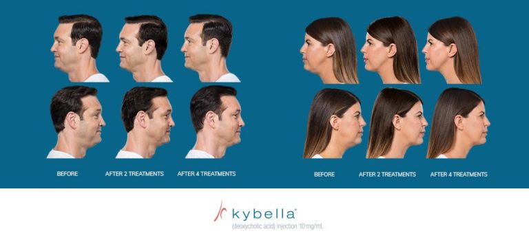 Kybella - LUX～A MEDICAL SPA